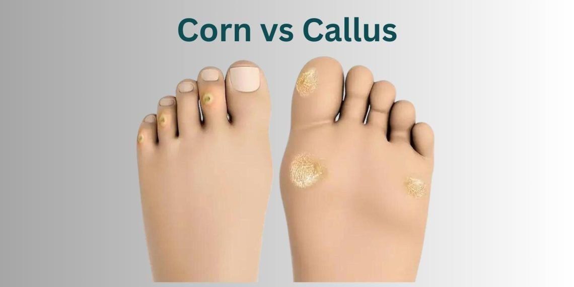 Corn vs Callus: What's the Difference?