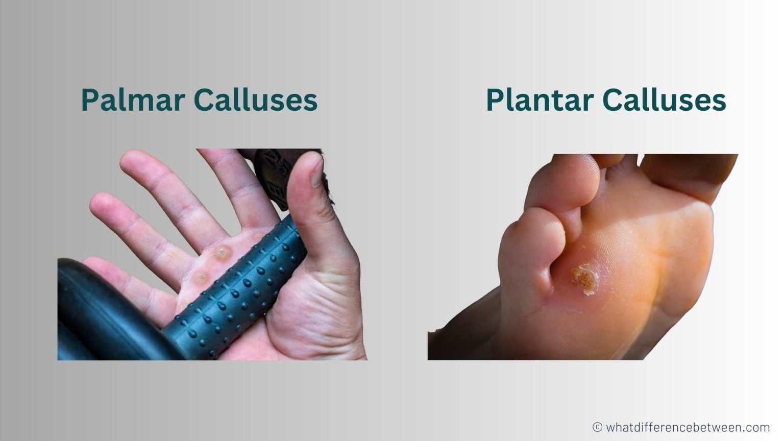 Corn Vs Callus Whats The Difference